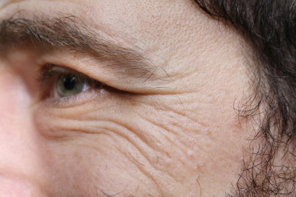 Glabellar Lines and How to Avoid Them - Particle