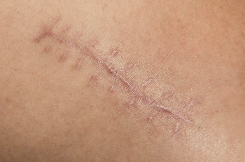 Combat Scarring & Aging: Causes, Solutions, & Skincare Tips